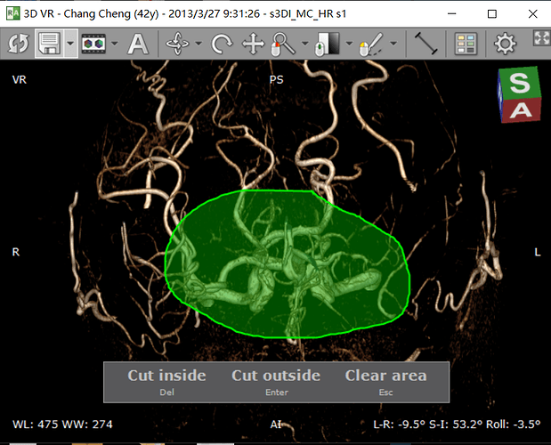 How To Crop 3D Image From A 2D Free hand ROI 2 By Lassoan Support VTK